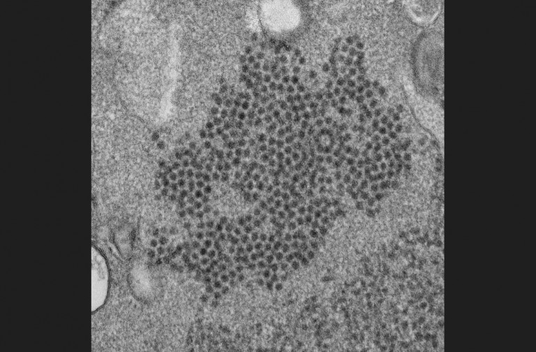 Estados Unidos alerta sobre el enterovirus D68